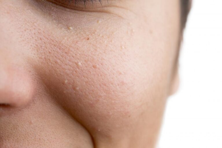 Unmasking Small Bumps On The Face Understanding And Treating Non Acne unmasking-small-bumps-on-the-face-understanding-and-treating-non-acne